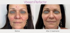 Laser Skin Resurfacing + Vbeam Laser Treatments